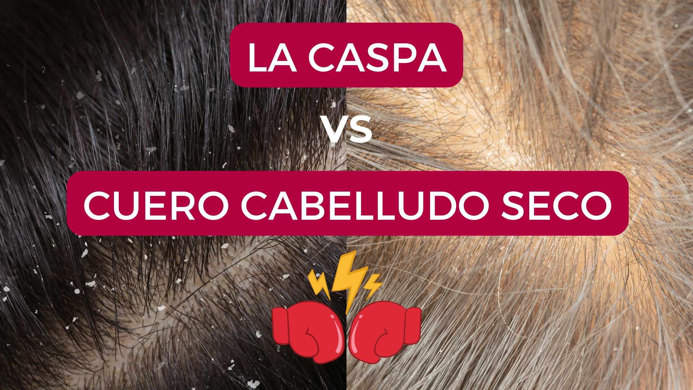 Cara a cara: Saber como quitar la caspa y cuero cabelludo seco